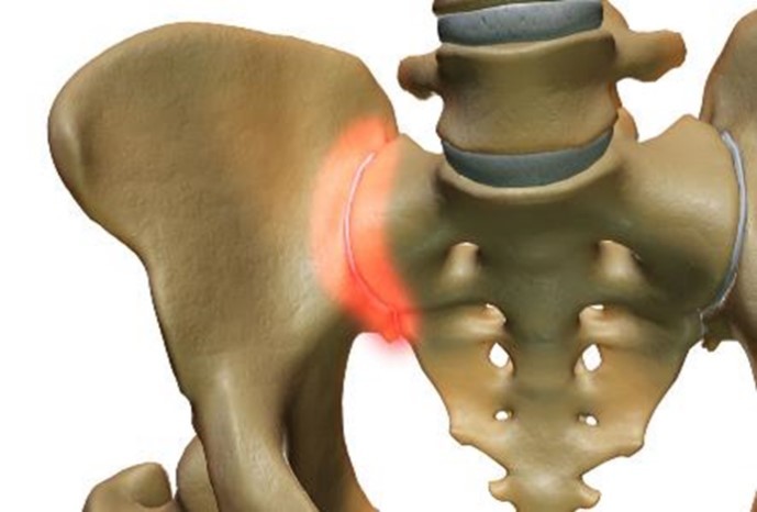 Rehabilitation for the SI Joint | SI-BONE