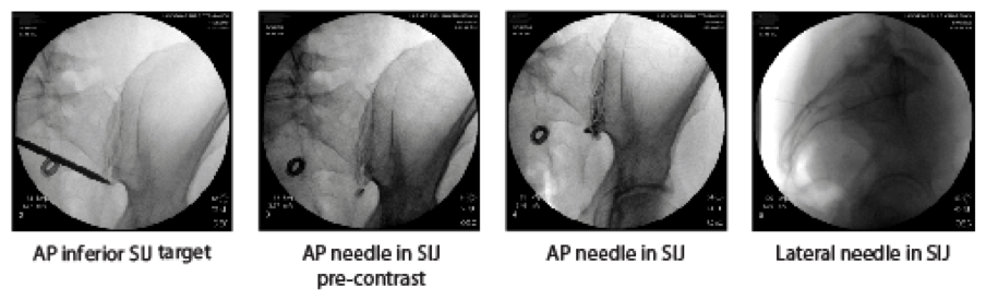 SI Joint Injection: The Diagnostic "Litmus Test" for SI Joint ...