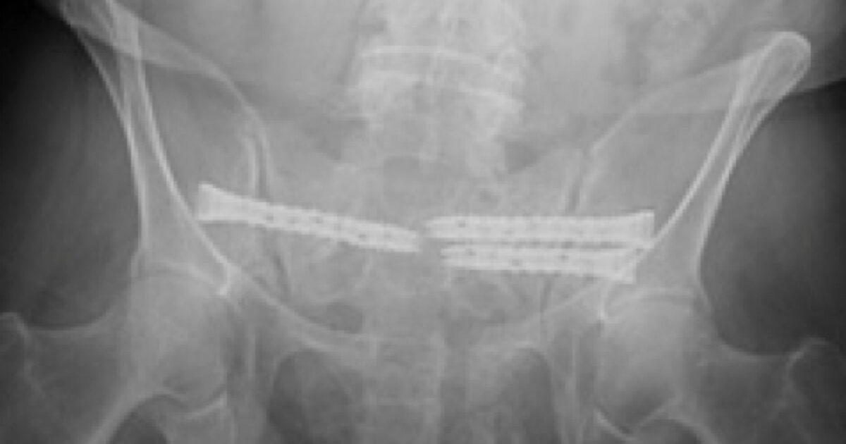 11462-121323: A Novel Approach to Pelvic Fracture Fixation | SI-BONE