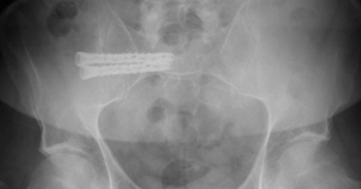 SI Joint Dysfunction After Metastatic Sarcoma | SI-BONE