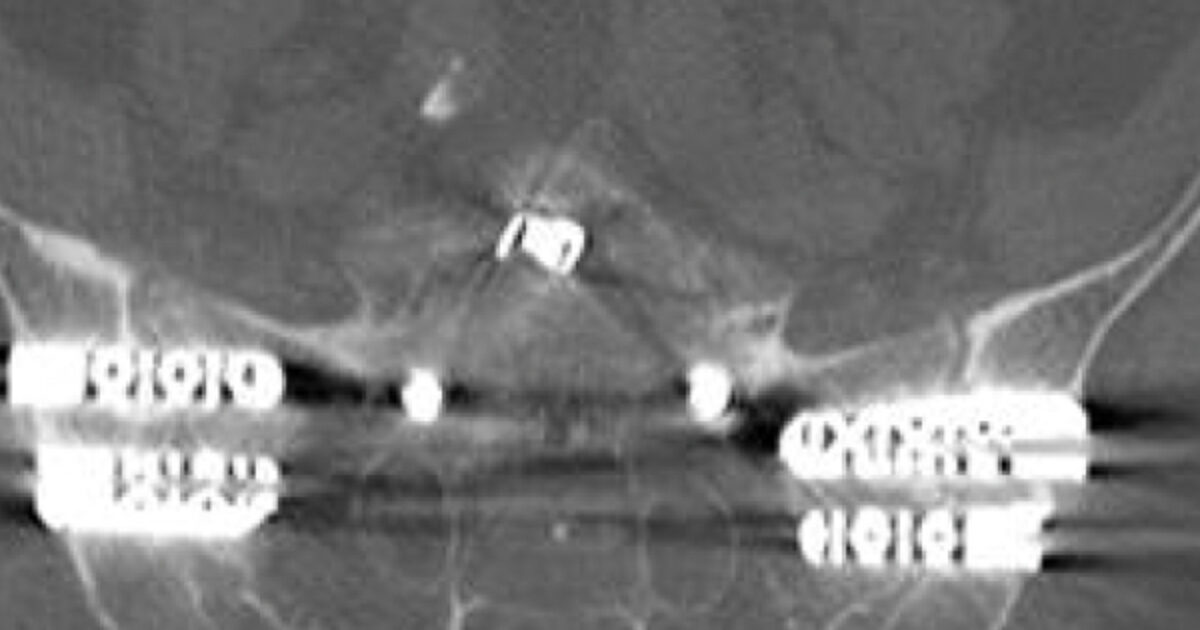 11609-073124: Treatment of SI Joint Dysfunction Post Lumbar Fusion | SI ...