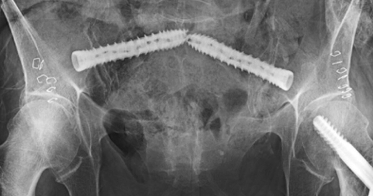 Fracture Fixation of U-Type Sacral Fragility Fracture | SI-BONE