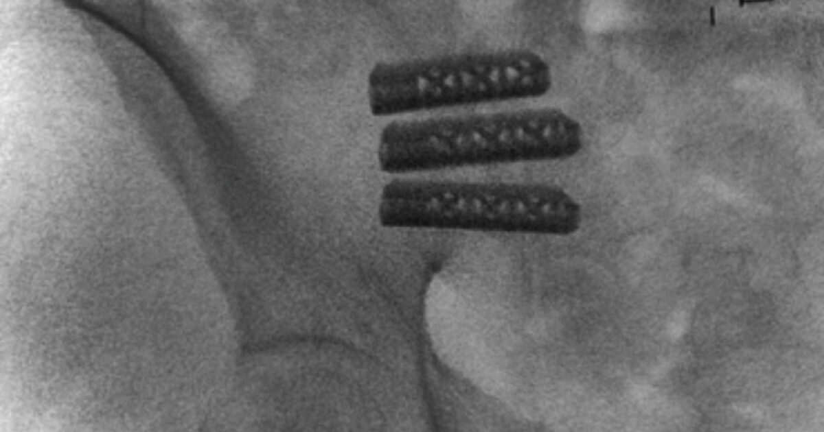 Sacroiliac Dysfunction Secondary to Chronic Degeneration | SI-BONE