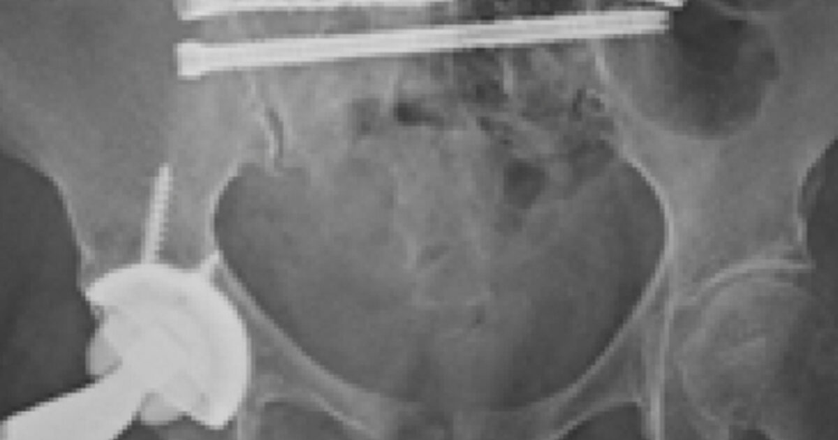 Sacral Insufficiency Fracture with Bilateral SI Joint Involvement | SI-BONE
