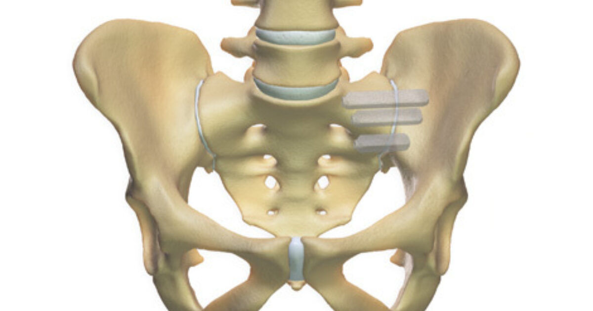 iFuse: Solutions for SI Joint Dysfunction | SI-BONE