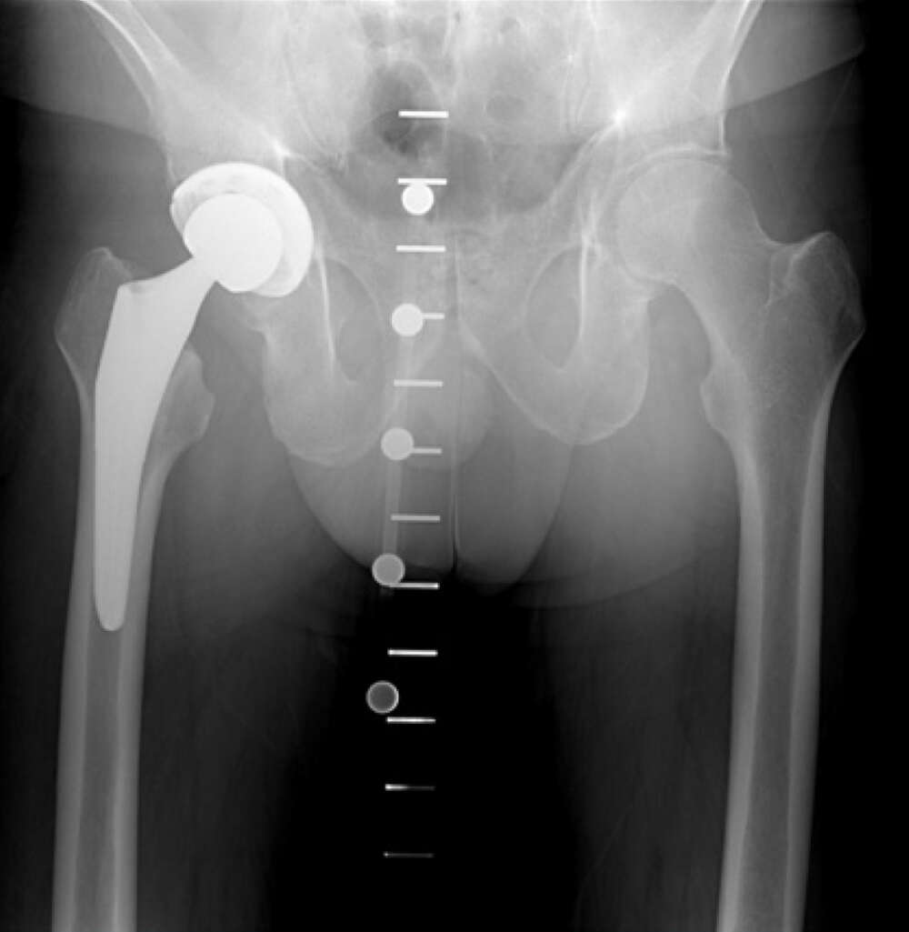 When Hip and SI Joint Pain Patterns Overlap | SI-BONE