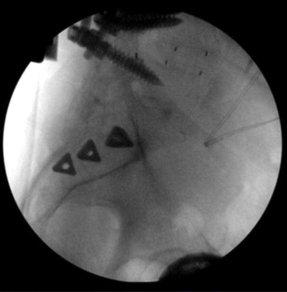 When Hip and SI Joint Pain Patterns Overlap | SI-BONE