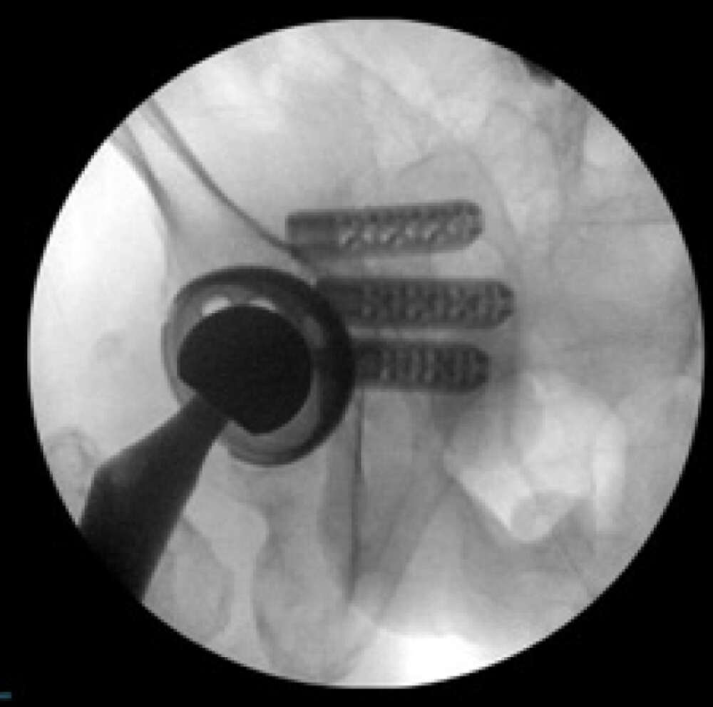 When Hip and SI Joint Pain Patterns Overlap | SI-BONE